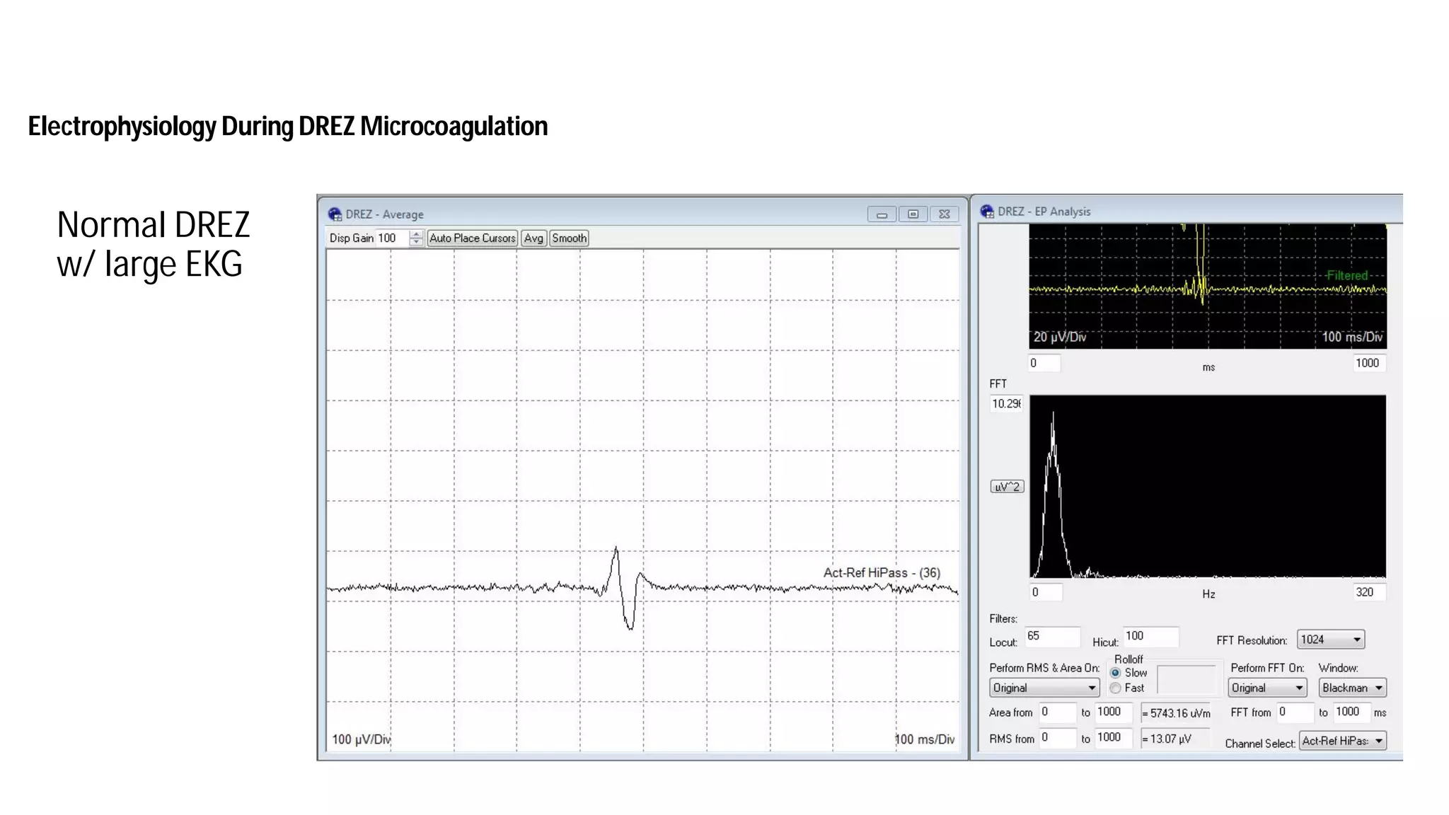 The Role of Electrophysiology During Dorsal Root Entry Zone ...