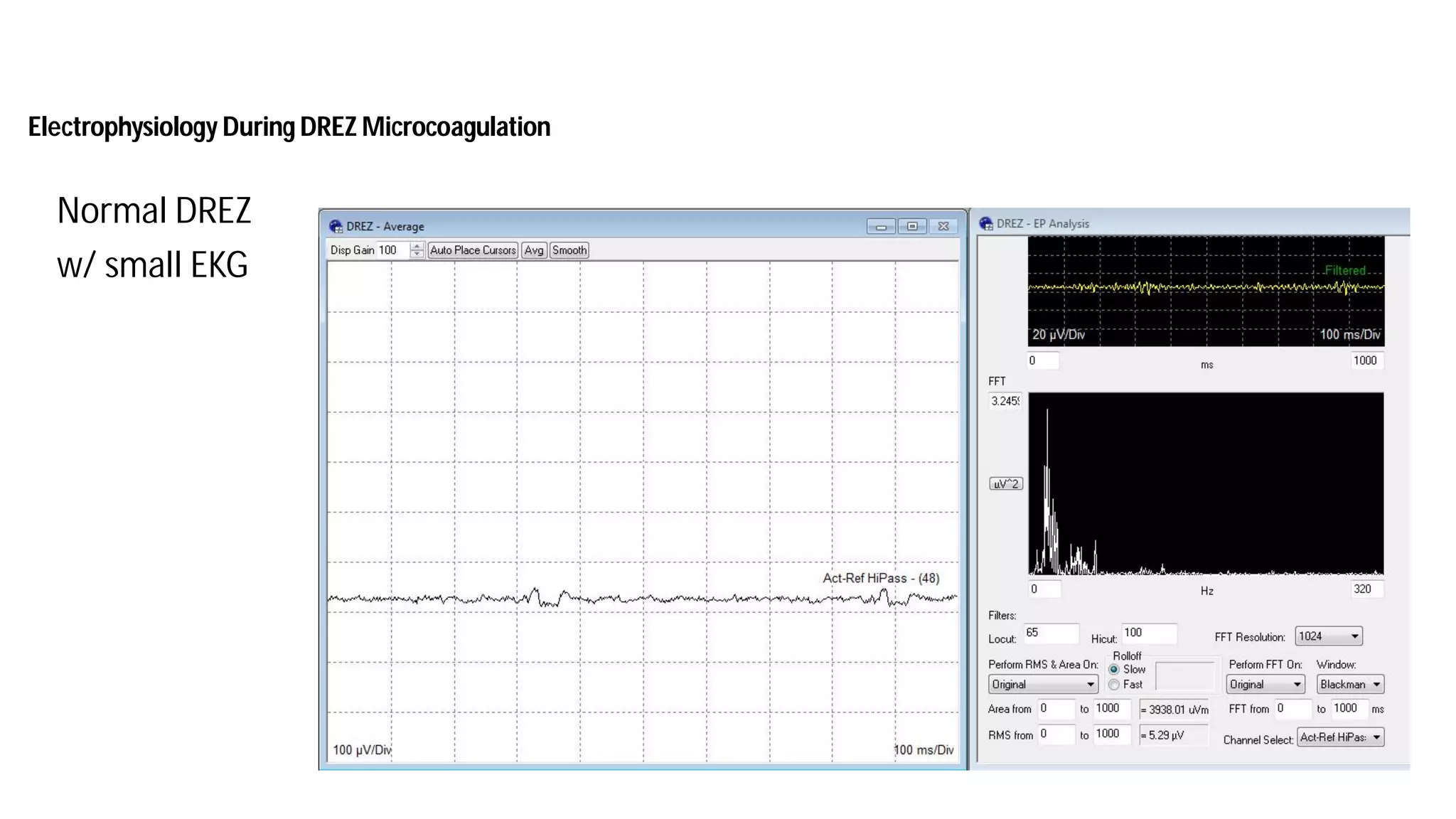 The Role of Electrophysiology During Dorsal Root Entry Zone ...