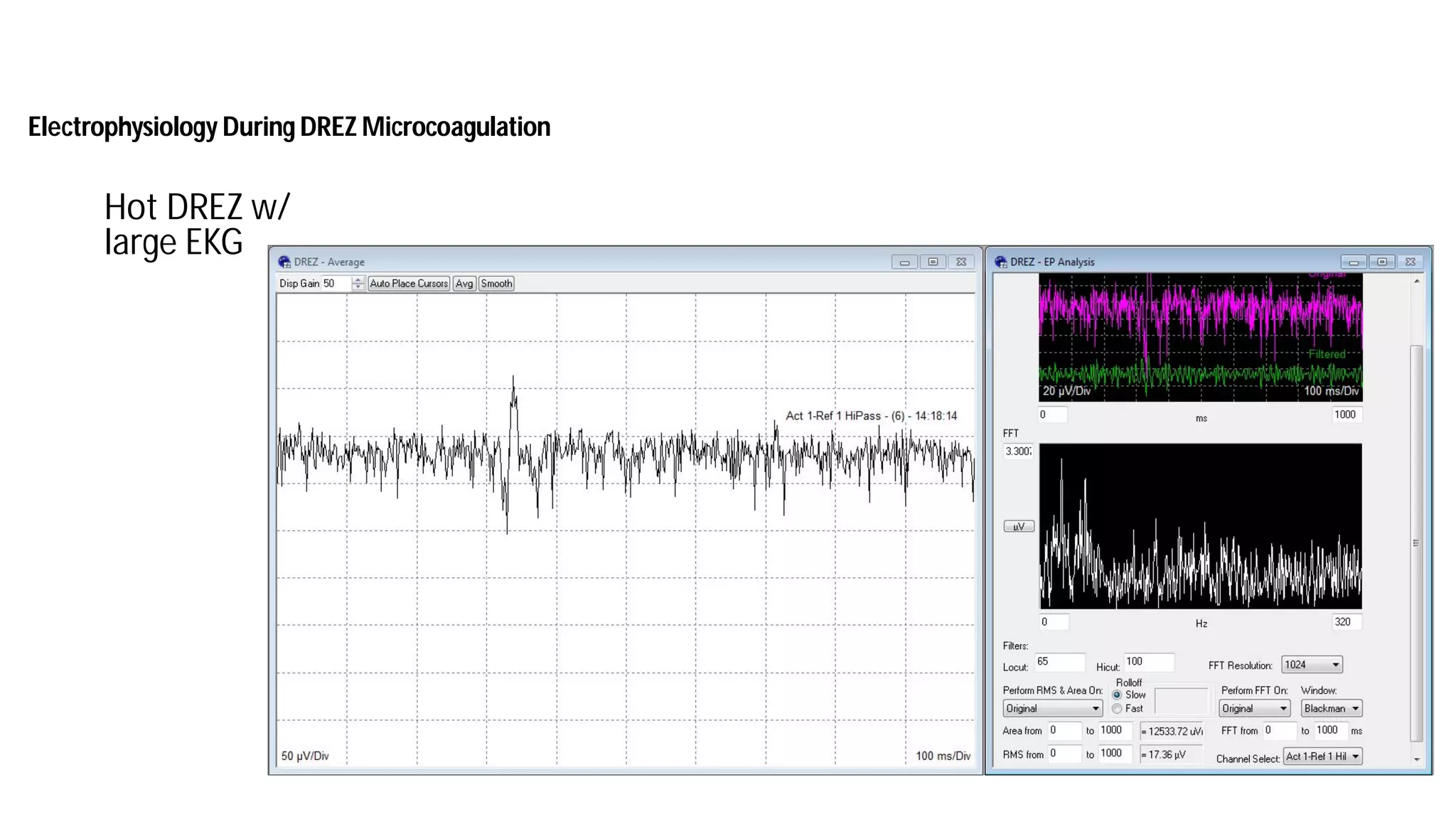The Role of Electrophysiology During Dorsal Root Entry Zone Microcoagulation To Treat ...