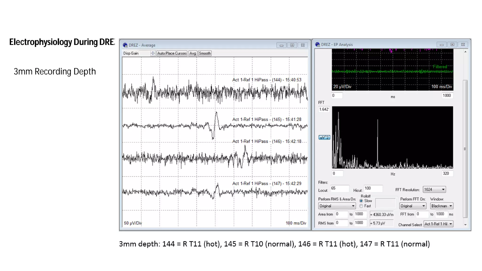 The Role of Electrophysiology During Dorsal Root Entry Zone Microcoagulation To Treat ...