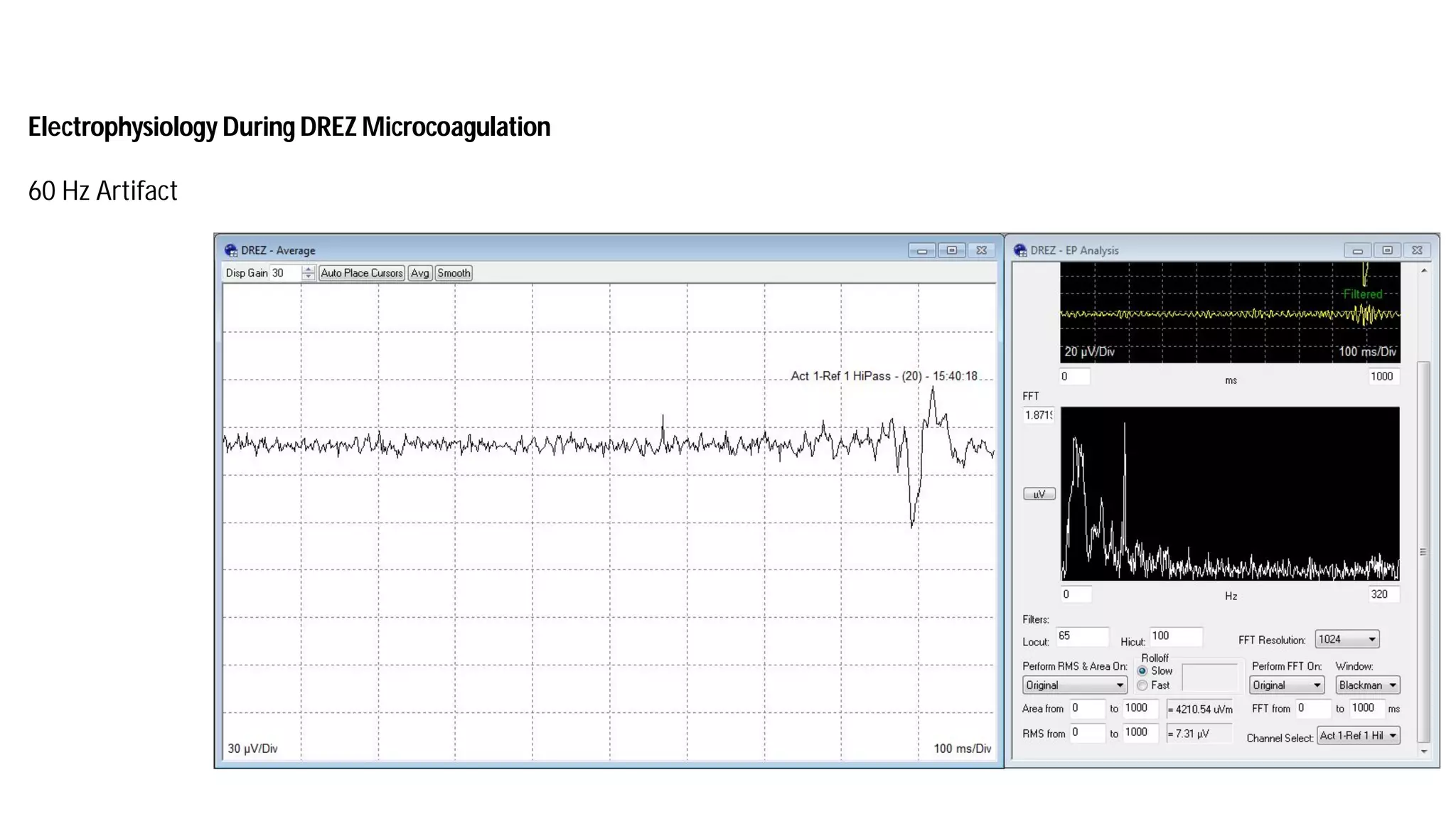 The Role of Electrophysiology During Dorsal Root Entry Zone Microcoagulation To Treat ...