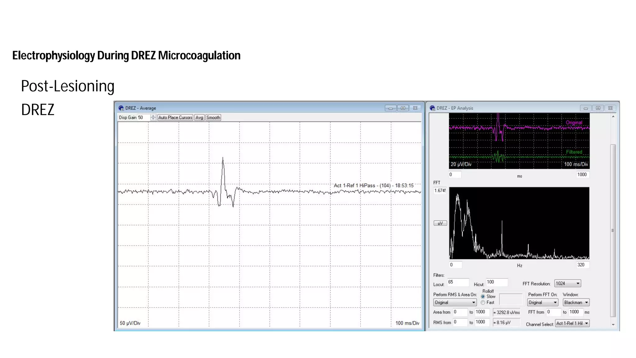 The Role of Electrophysiology During Dorsal Root Entry Zone Microcoagulation To Treat ...