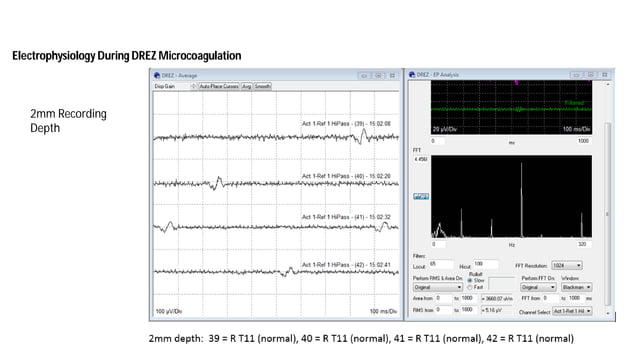 The Role of Electrophysiology During Dorsal Root Entry Zone ...