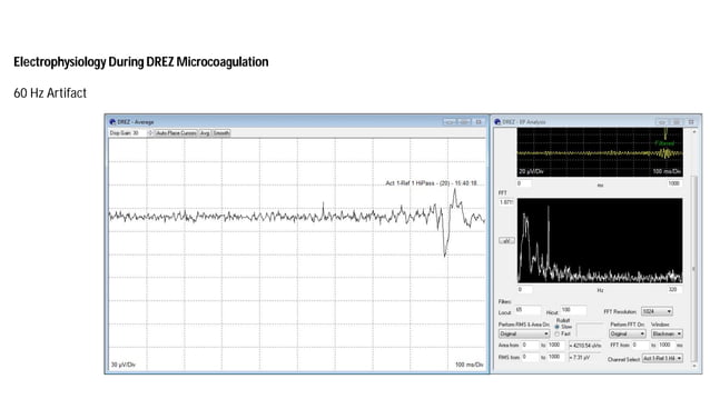 The Role of Electrophysiology During Dorsal Root Entry Zone Microcoagulation To Treat ...