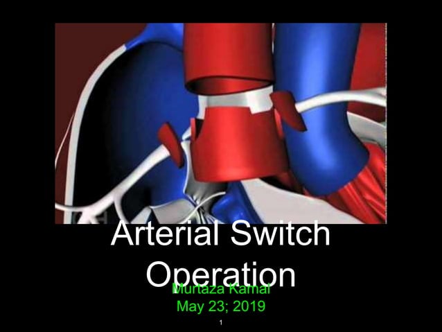 ASO: ARTERIAL SWITCH OPERATION | PPTX | Heart and Cardiovascular ...