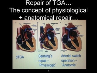 ASO: ARTERIAL SWITCH OPERATION | PPTX