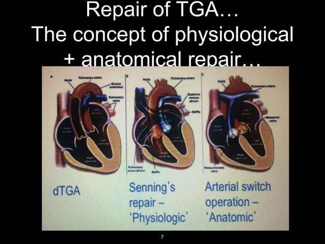 ASO: ARTERIAL SWITCH OPERATION | PPTX | Heart and Cardiovascular ...