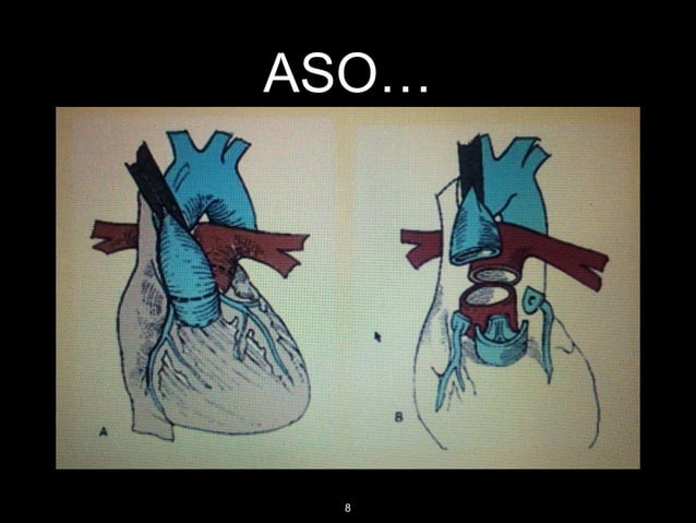 ASO: ARTERIAL SWITCH OPERATION | PPTX | Heart and Cardiovascular ...