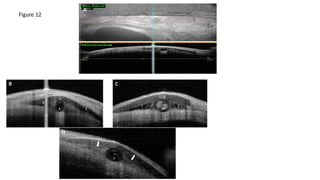 ASOCT Glaucoma Figures PPT/photos of OCT | PPT