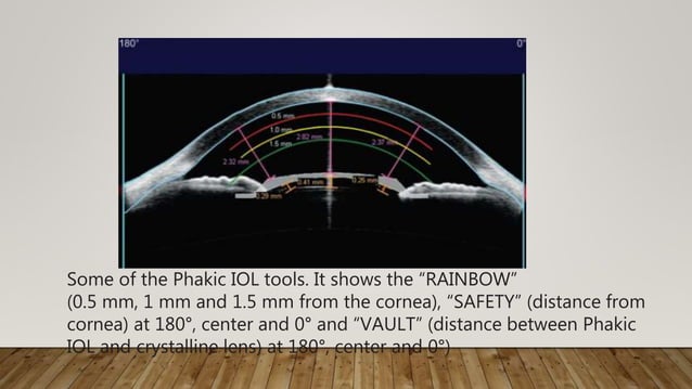 Anterior segment OCT & UBM | PPTX | Eye and Vision Conditions ...