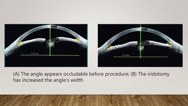 Anterior segment OCT & UBM | PPTX | Eye and Vision Conditions ...
