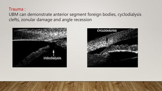 Anterior segment OCT & UBM | PPT