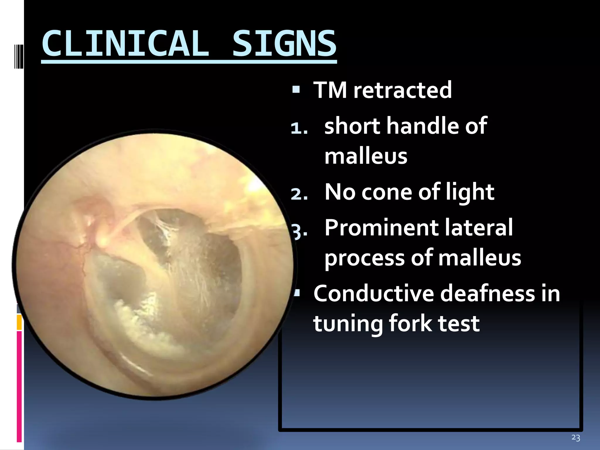 Acute Otitis Media | PPTX