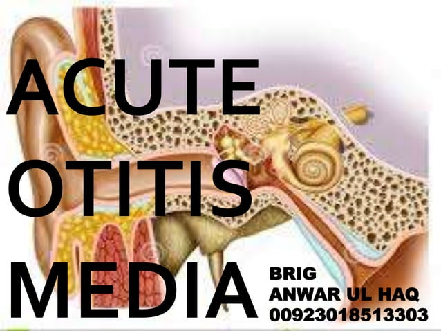 Acute Otitis Media | PPTX | Ear, Nose and Throat Conditions | Diseases ...