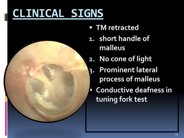 Acute Otitis Media | PPTX | Ear, Nose and Throat Conditions | Diseases ...