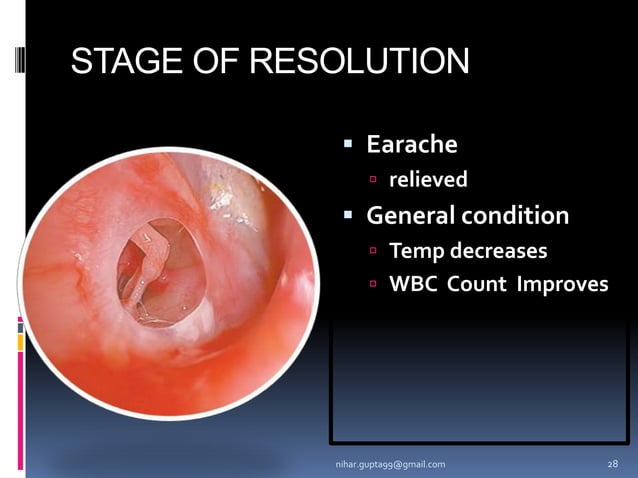 Acute Otitis Media | PPT