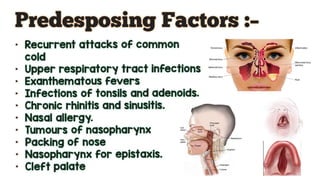 ASOM (Acute Suppurative Otitis Media..).pptx