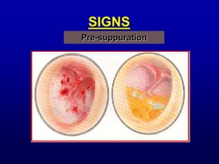 ACUTE SUPPURATIVE OTITIS MEDIA FOR UNDERGRADUATES | PPT