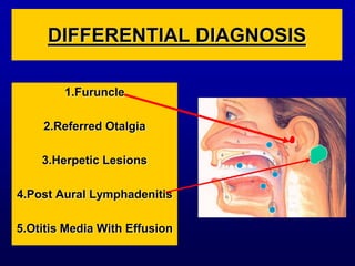 ACUTE SUPPURATIVE OTITIS MEDIA FOR UNDERGRADUATES | PPT