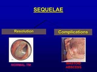 ACUTE SUPPURATIVE OTITIS MEDIA FOR UNDERGRADUATES | PPT