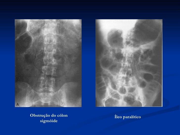 Aspectos Clínicos e Radiológicos da Obstrução Intestinal