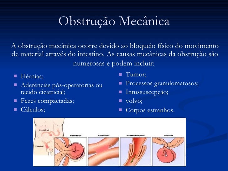 Aspectos Clínicos e Radiológicos da Obstrução Intestinal