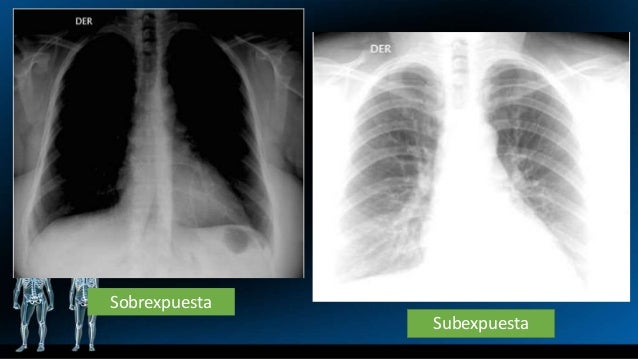 Aspectos técnicos de la radiografía de tórax