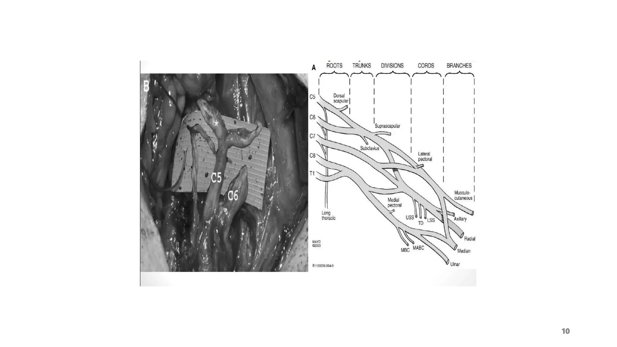 Aspek elektroneurofisiologis erb dan klumpke palsy | PPT