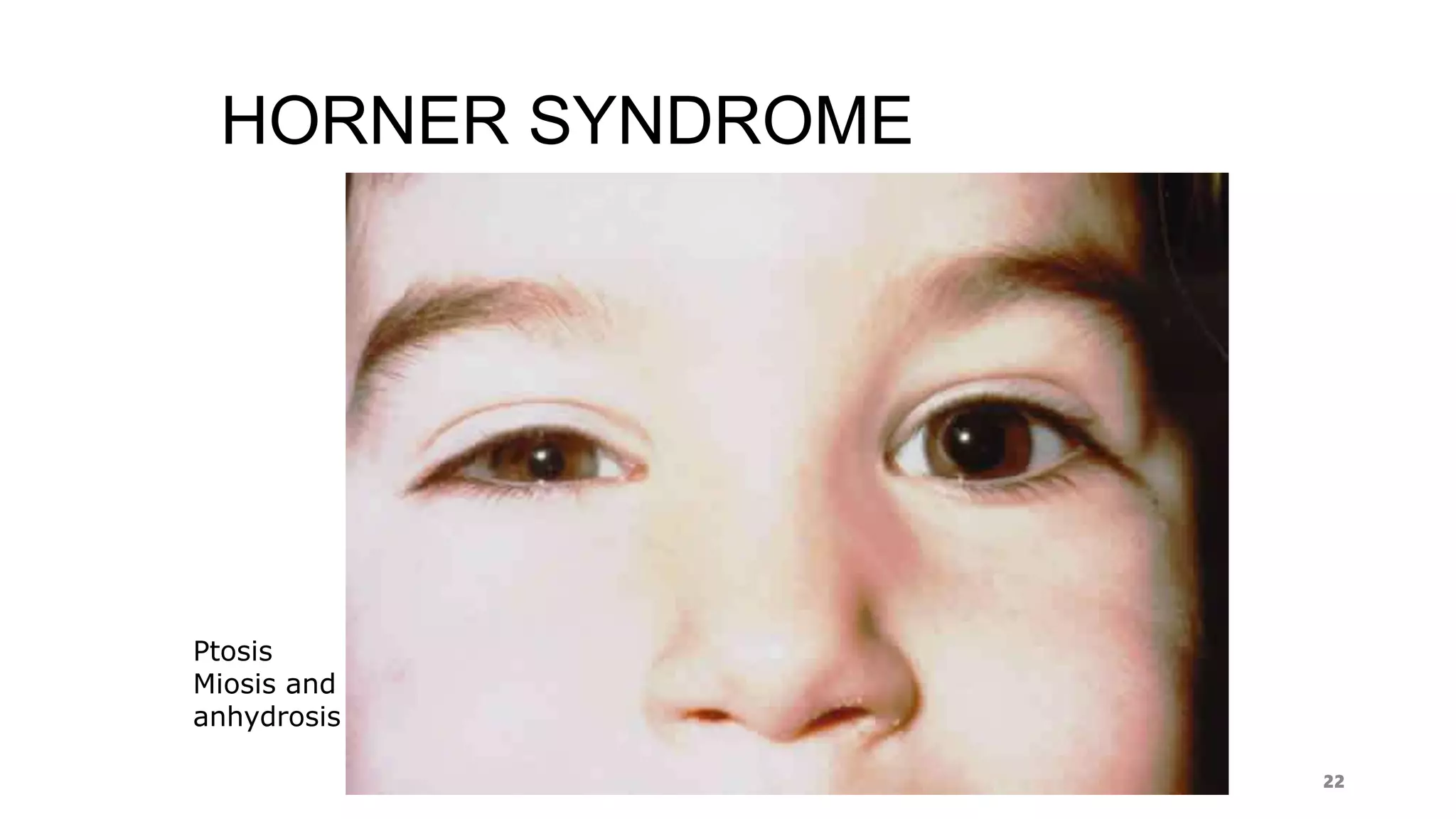 Aspek elektroneurofisiologis erb dan klumpke palsy | PPT