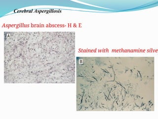 ASPERGILLOSIS....fungal zoonosis....pptx
