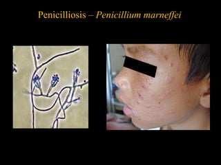 Penicillium Marneffei
