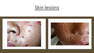 Aspergillus & penicillium | PDF | Infectious Diseases | Diseases and ...