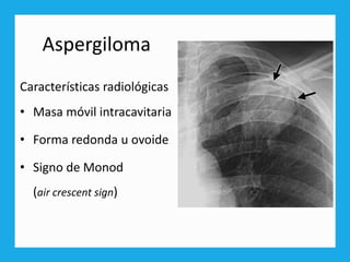 Aspergillus spp - Aspergilosis | PPTX