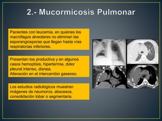 Aspergilosis y cigomicosis | PPTX