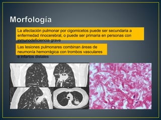 Aspergilosis y cigomicosis | PPTX