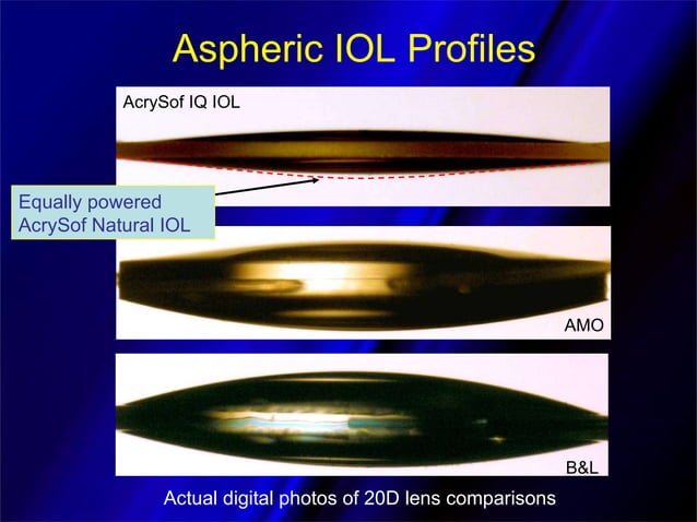 Aspheric IOLs for CRGH | PPT | Eye and Vision Conditions | Diseases and ...