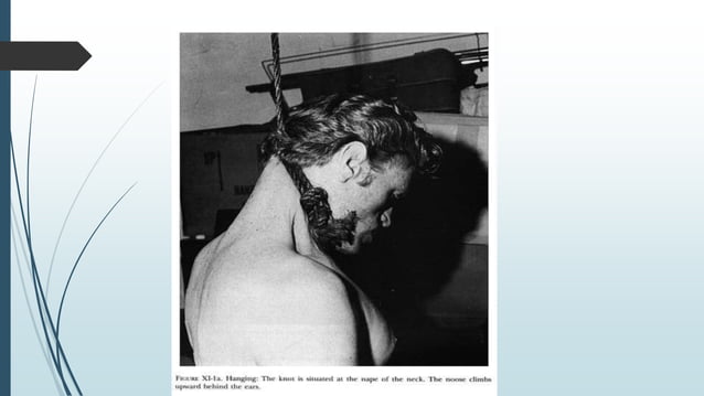 All about asphyxia in forensic medicine.1.pptx | First Aid | Injuries