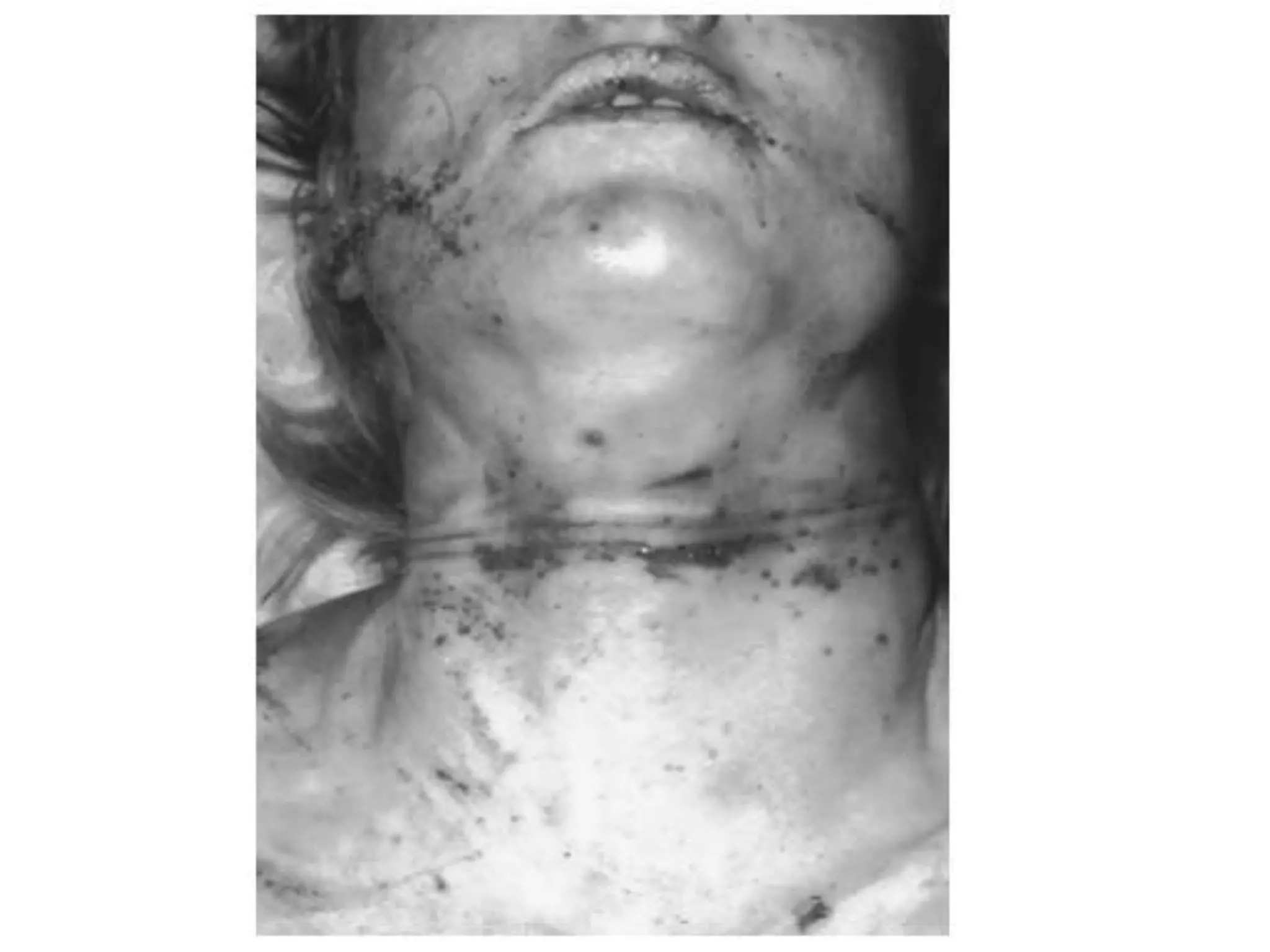 Asphyxia presentation | PPTX