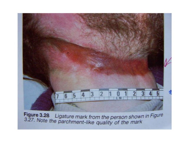 Asphyxia presentation | PPTX | Injuries | Diseases and Conditions