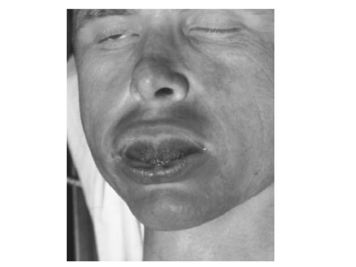 Asphyxia presentation