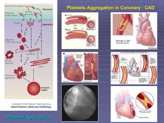 Aspilet Therapy After CABG Sirgery | PPS
