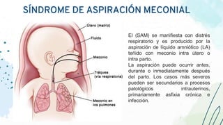 ASPIRACIÓN MECONIAL | PPTX