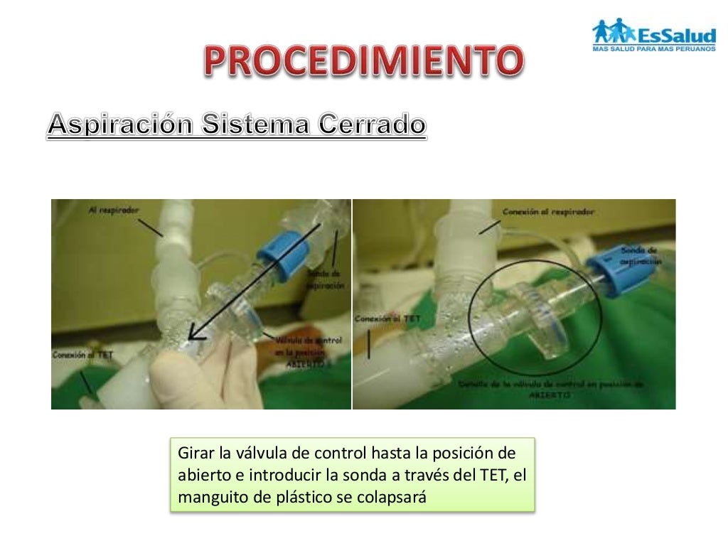Aspiracion De Secreciones De La Via Respiratoria Baja Via Respiratoria ...