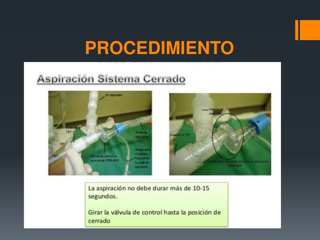 Aspiracion de secreciones sistema abierto y cerrado Aspiracion de secreciones sistema abierto y cerrado