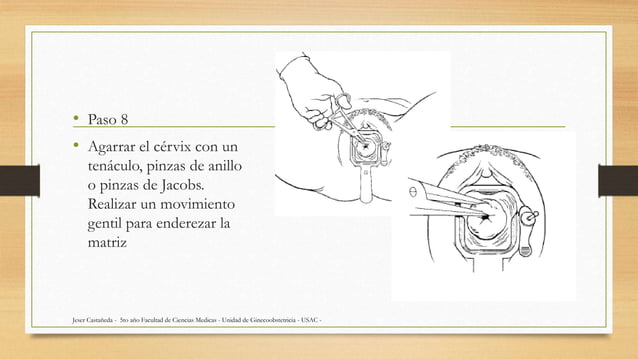 Aspiracion manual endo uterina - AMEU | PPTX