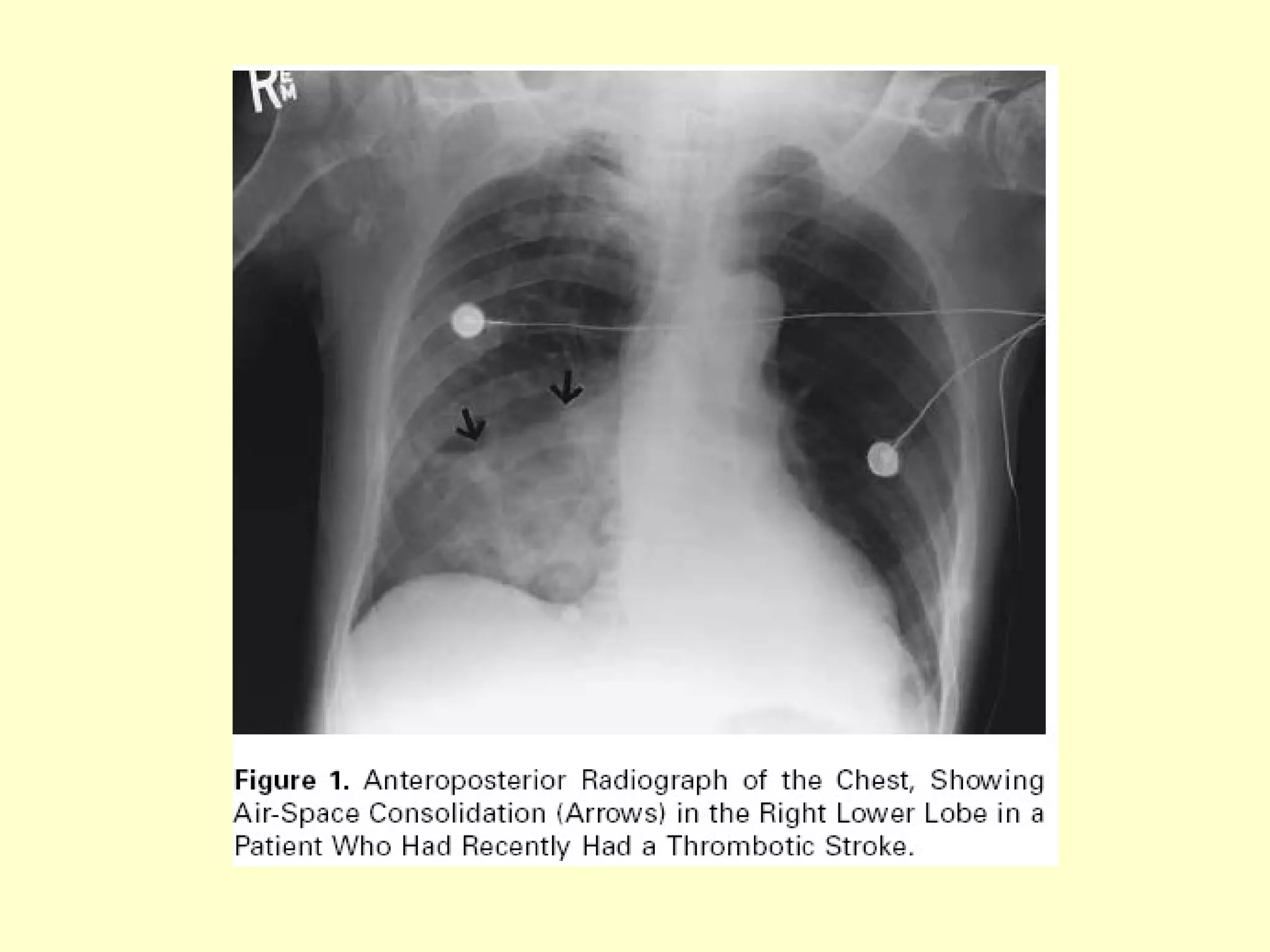Aspiration Pneumonia | PPT