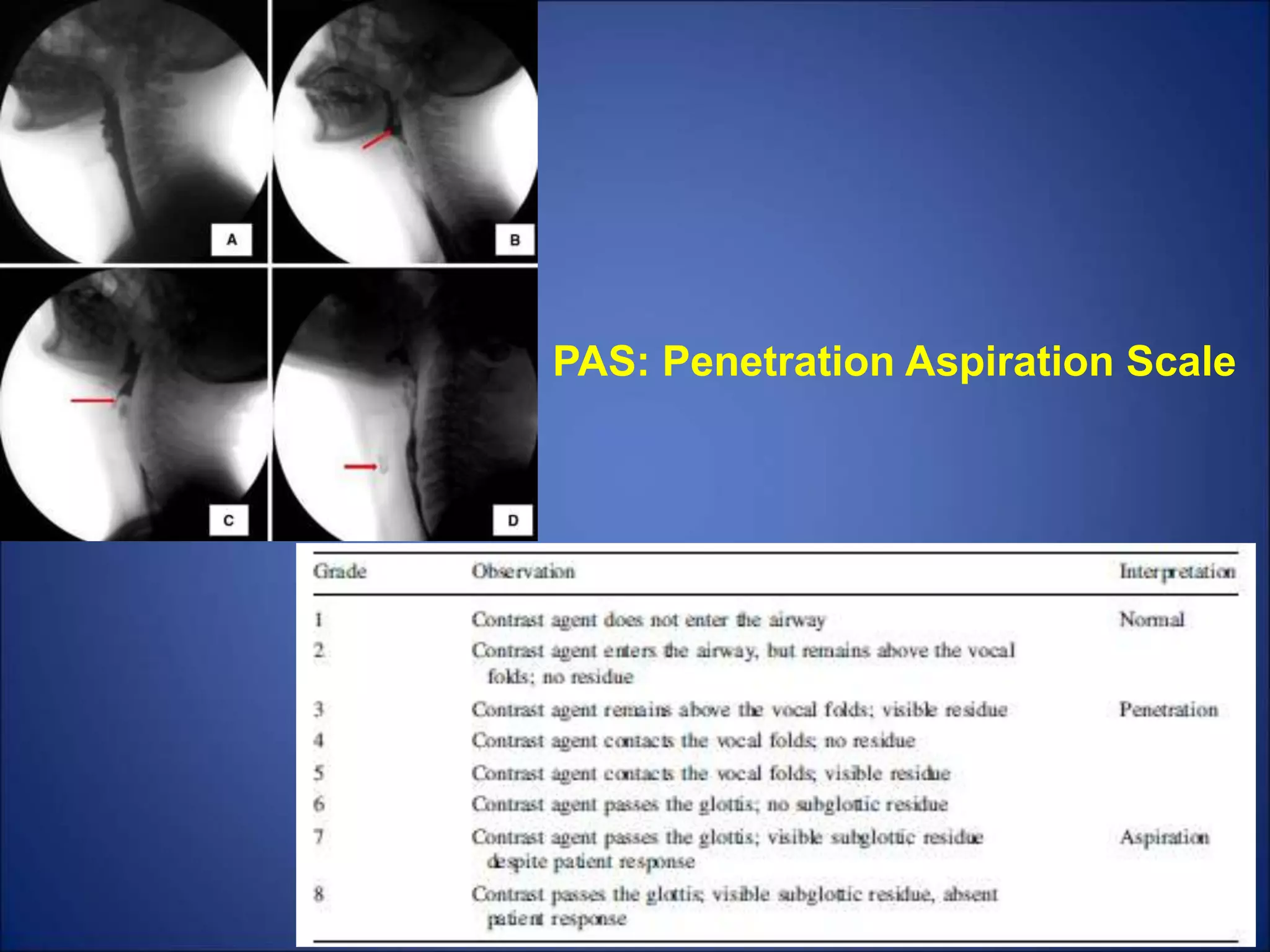 Aspiration pneumonia in head and neck cancer patients | PPTX