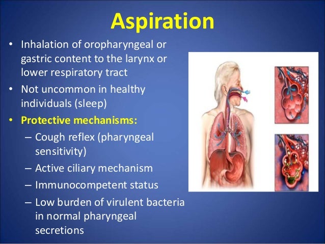 Aspiration pneumonia in head and neck cancer patients