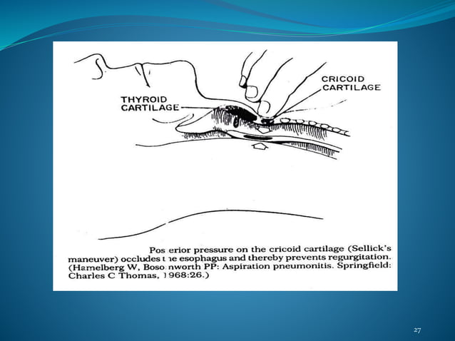 Aspiration prophylaxis in full stomach | PPTX | Lung and Respiratory ...