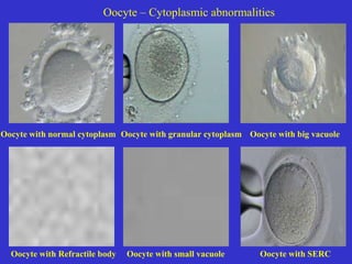 IVF - Training in India -Dr.VM.Thomas,PhD,FSAB:chennai fertility center ...